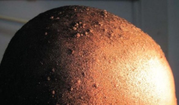 Scalp Warts Causes, Symptoms, Treatments and Removal - Strong Hair