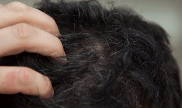 Tender, Sensitive, and Painful Scalp Causes & Treatments - Strong Hair