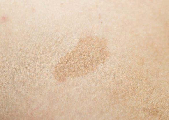 Birthmark in Hair and Scalp: Types, Causes, and Treatment - Strong Hair